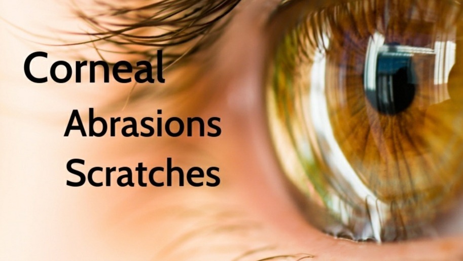 Eye injuries: Corneal abrasion or Scratched cornea.